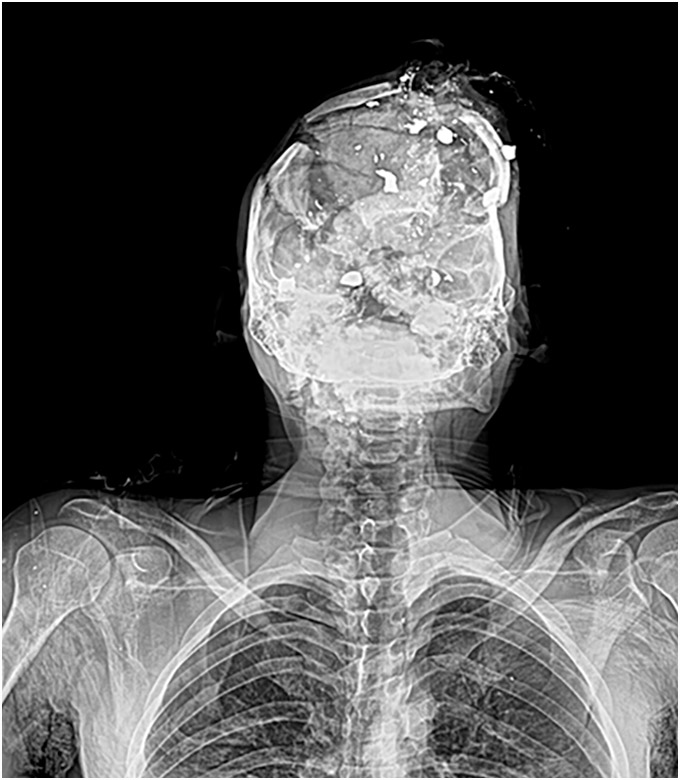 Advancing Forensic Anthropology: Imaging Innovations - Linev Innovations