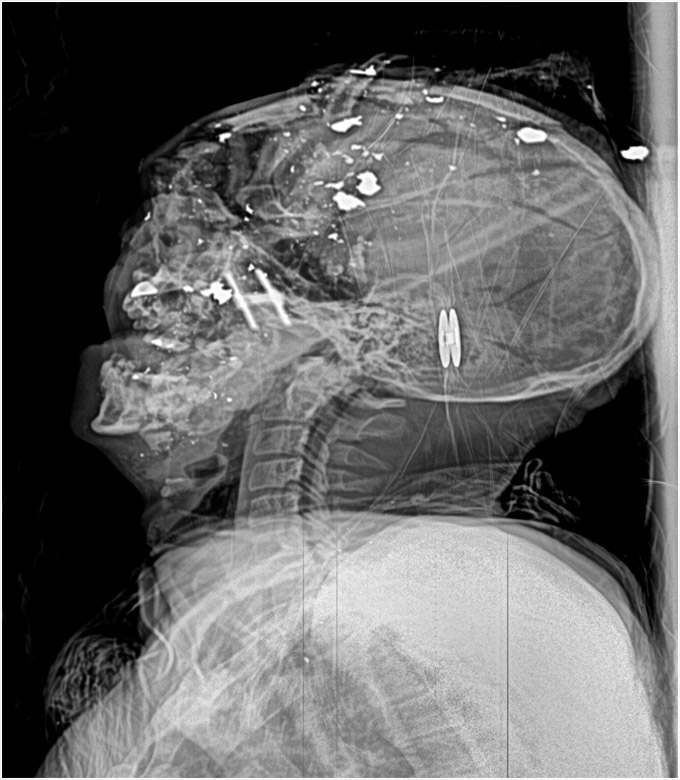 Advancing Forensic Anthropology: Imaging Innovations - Linev Innovations